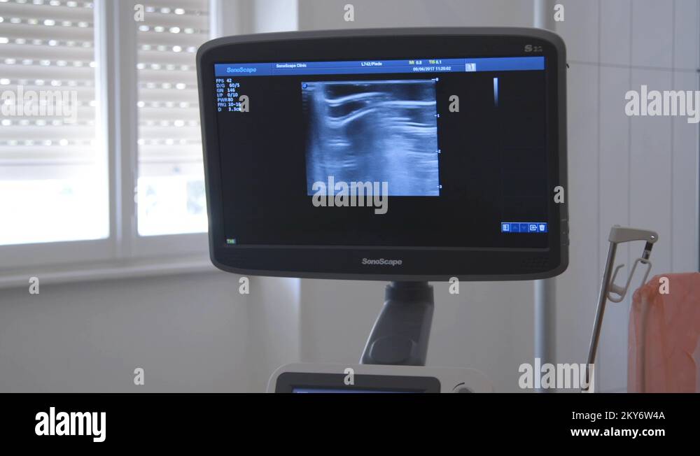 Ultrasound monitor showing ultrasonography in hospital Stock Video ...