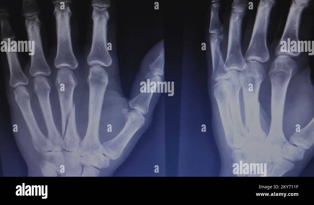 Bone fracture xray Stock Videos & Footage - HD and 4K Video Clips - Alamy