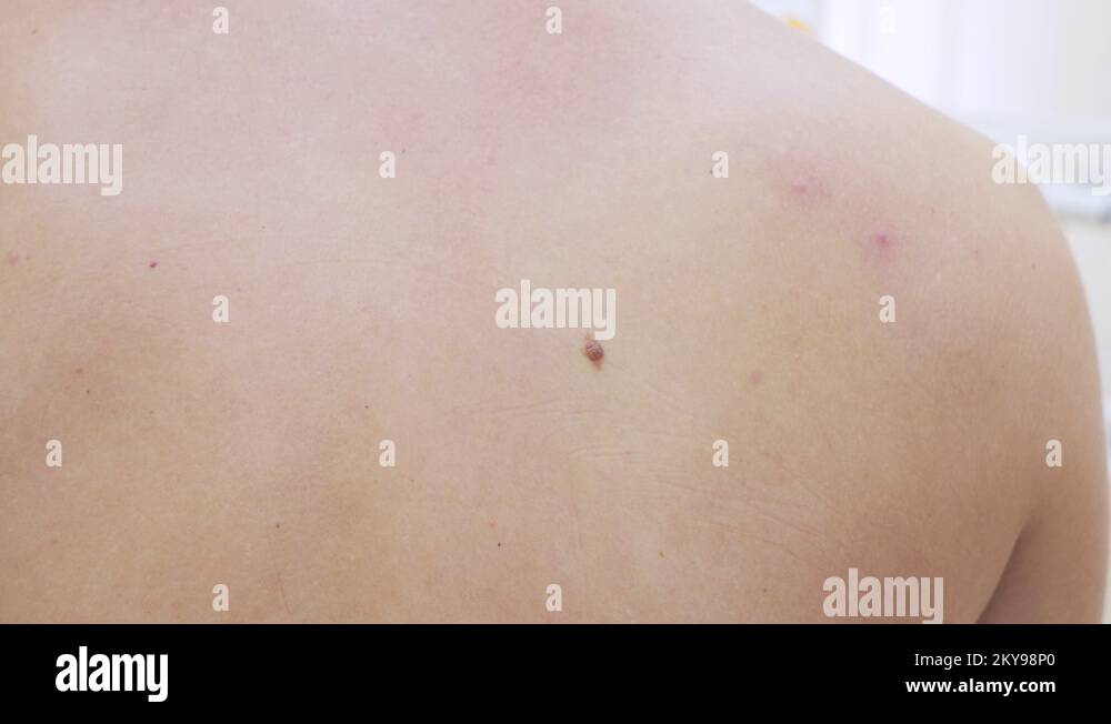 doctor dermatovenereologist makes an injection of anesthesia in the ...