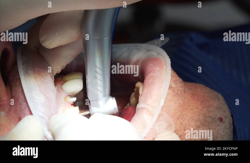 Process of drilling an old tooth before putting on a new dental crown ...