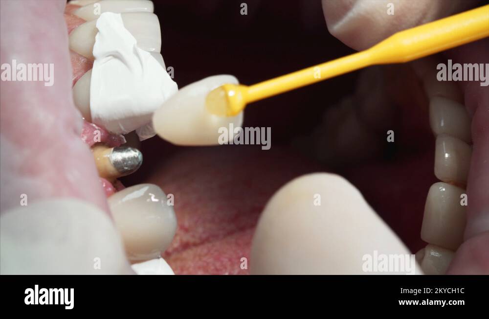 Process of dental crown installation. Close view of patient's opened ...