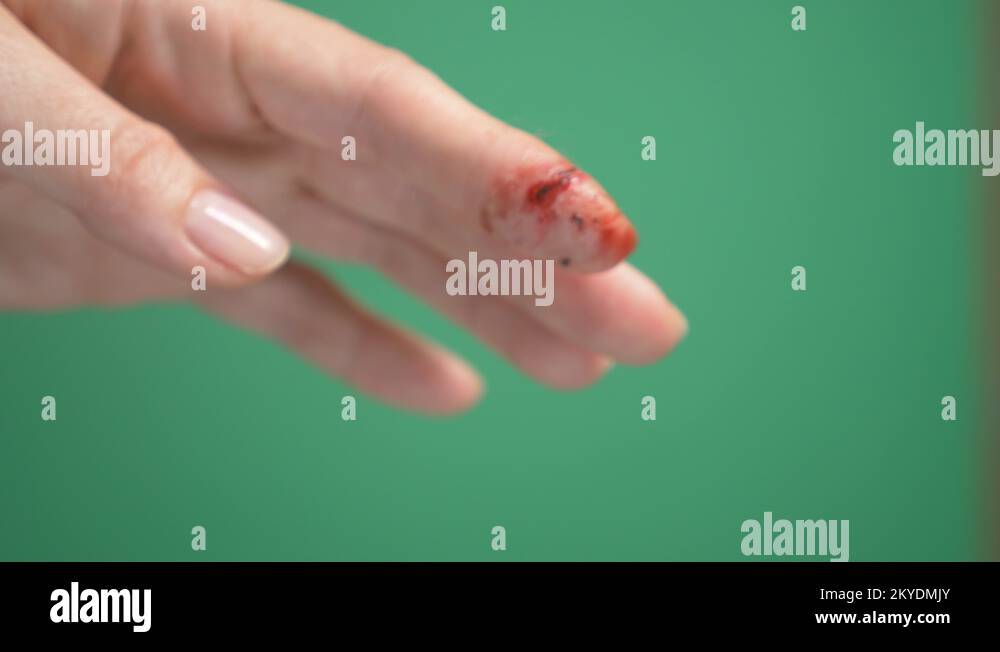Cut finger hospital Stock Videos & Footage - HD and 4K Video Clips - Alamy