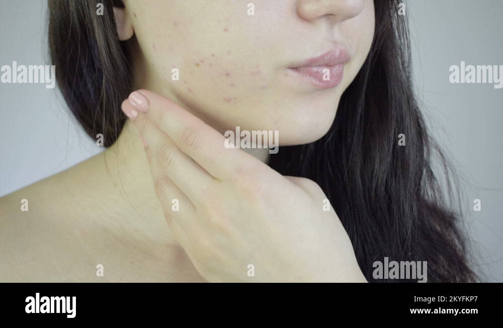 A brunette girl looks at her face. Her cheeks are covered with red acne ...