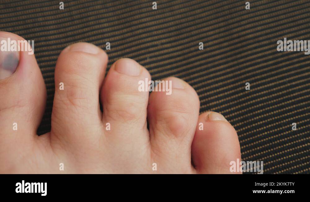 Sick nail. Trauma to the nail. Toes for legs. Bruise under the thumb ...