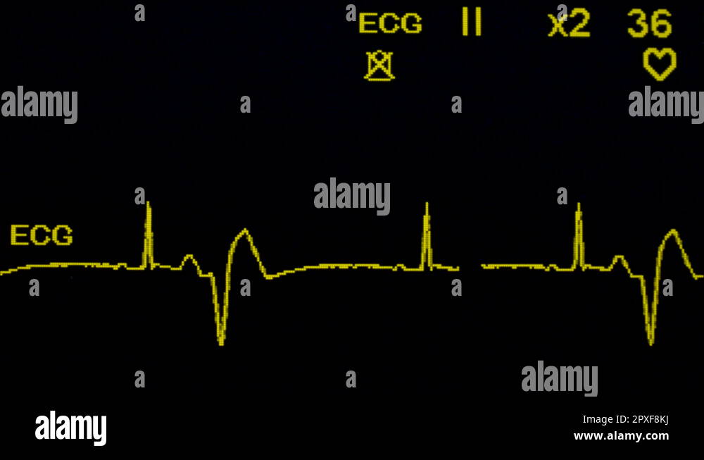 Ekg abnormal Stock Videos & Footage - HD and 4K Video Clips - Alamy