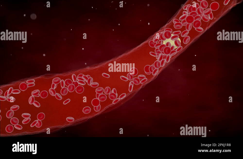 Artery plaque Stock Videos & Footage - HD and 4K Video Clips - Alamy
