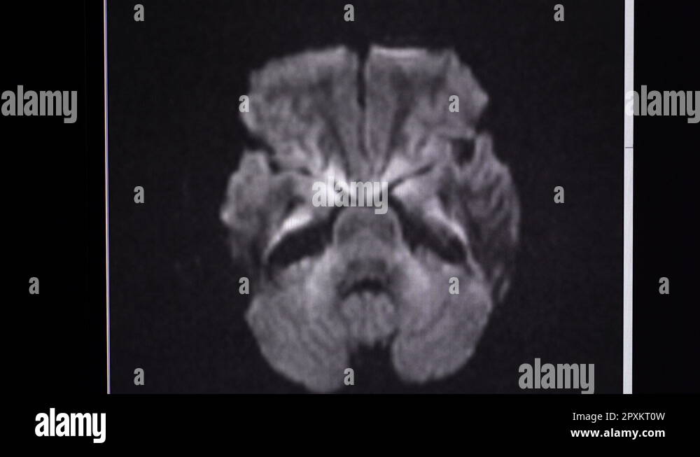 MRI brain scan, side view, top view Stock Video Footage - Alamy