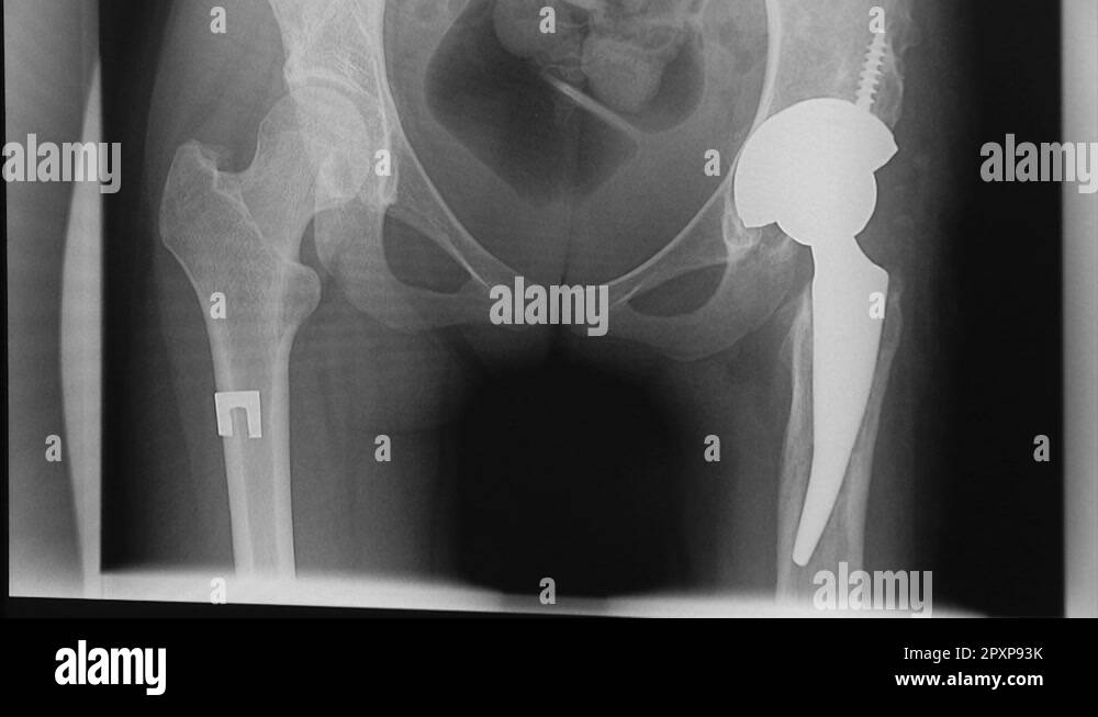 Artificial hip joint x ray Stock Videos & Footage - HD and 4K Video ...