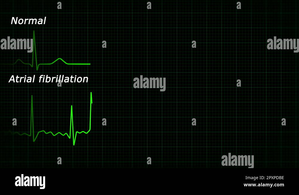 Electrocardiogram atrial fibrillation Stock Videos & Footage - HD and ...