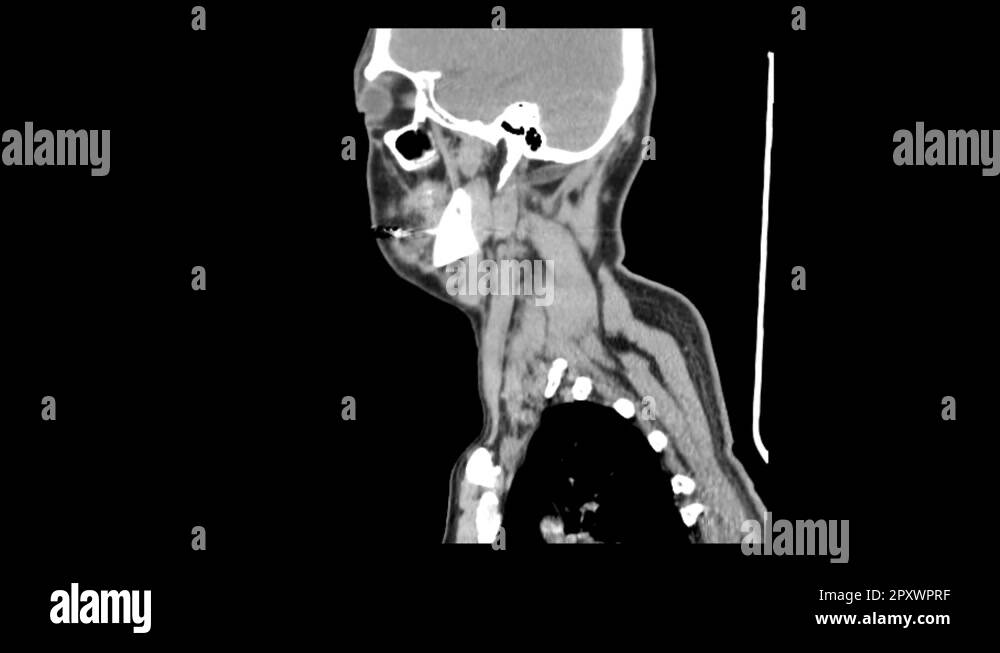 Ct scan of neck Stock Videos & Footage - HD and 4K Video Clips - Alamy