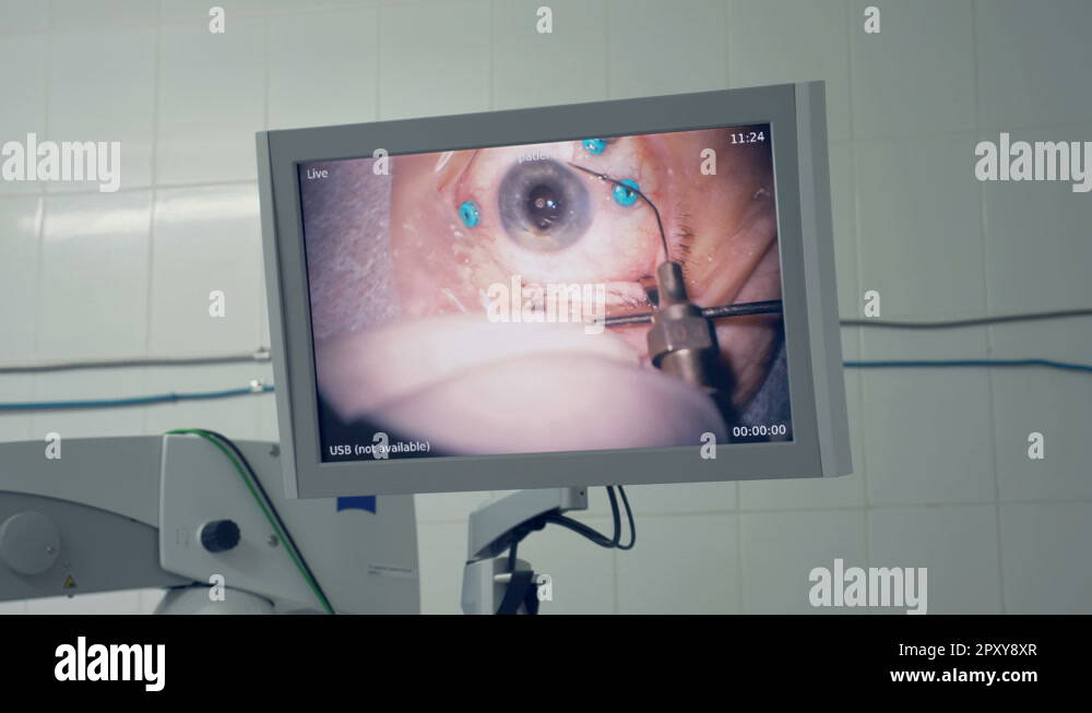 A feed of an eye surgery shown on a large screen Stock Video Footage ...