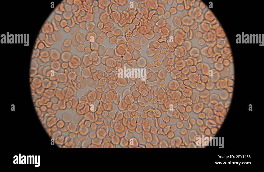 Granulocytes Stock Videos & Footage - HD and 4K Video Clips - Alamy