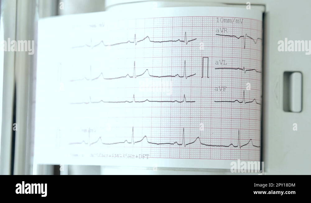 Doctor prints on the ECG ECG printer close-up Stock Video Footage - Alamy