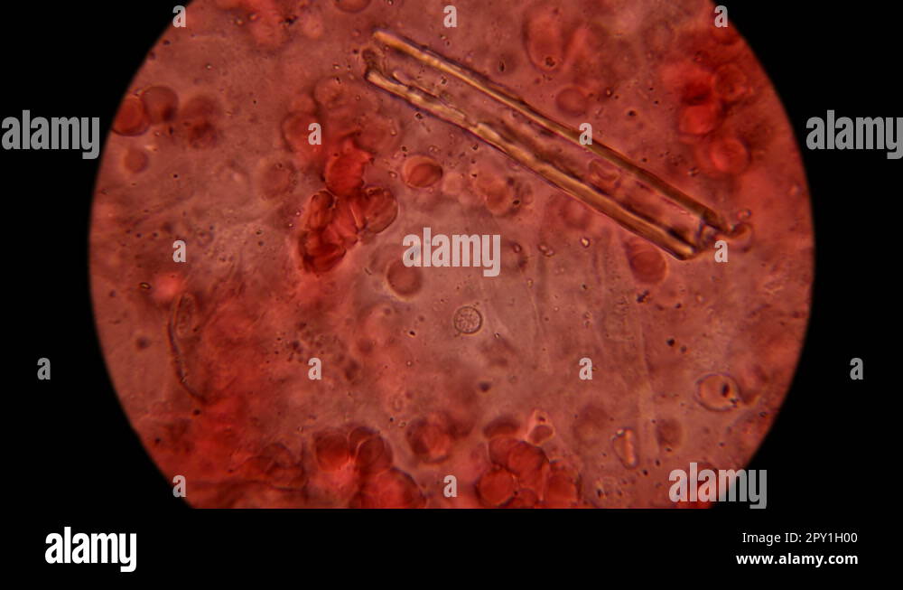 menstrual blood with its microflora and bacteria under microscope Stock ...