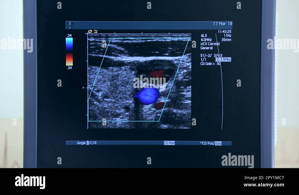Doppler ultrasound machine Stock Videos & Footage - HD and 4K Video ...