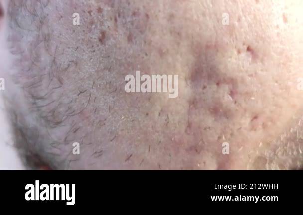 A detailed look at facial skin texture, highlighting small bumps and ...