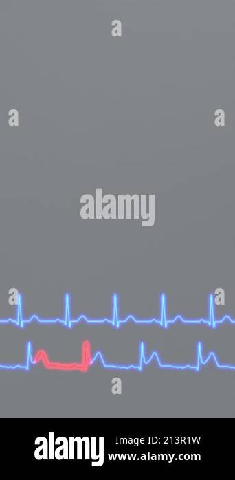 ECG comparison of the normal heart rhythm of a healthy patient and the ...