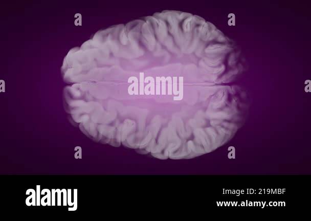 Detailed MRI of the brain showing the impact of an ischemic stroke with ...