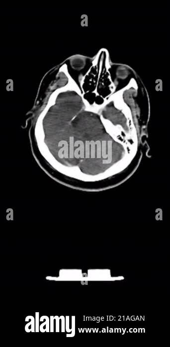 Cross section brain anatomy Stock Videos & Footage - HD and 4K Video ...