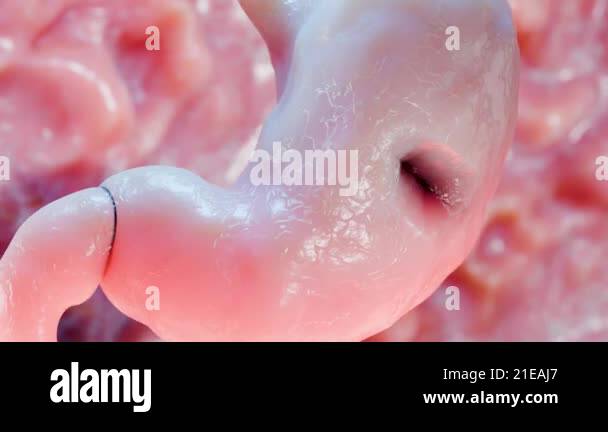 Stomach cancer. stages tumor growth in digestive system, Peptic Ulcer ...