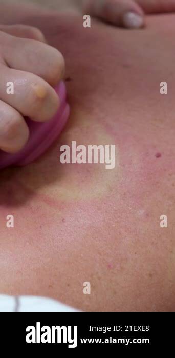 Therapist Heating Suction Cups Using Fire Cupping Stick and Putting ...