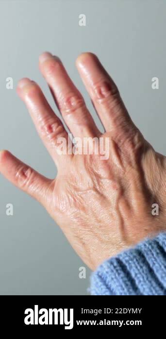 Senior woman showing her hand deformed by rheumatoid arthritis ...