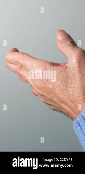 Rheumatoid arthritis causing visible hand deformation, showcasing joint ...
