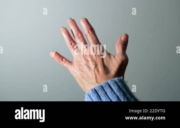 Elderly woman's severely deformed hand exposing painful rheumatoid ...