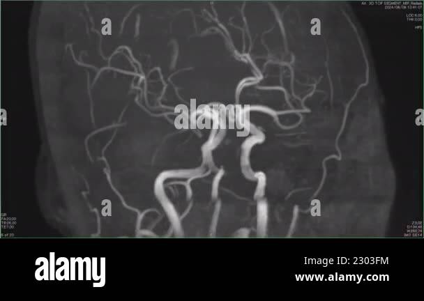 Magnetic resonance images of the brain, MRI of the brain, of a patient ...