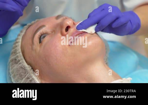 Close up woman lip augmentation procedure. Beautician wipe away blood ...