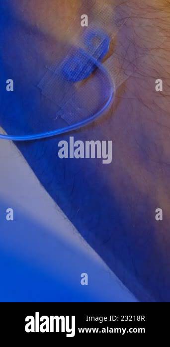 The image of serum attached to the arm in blue light, intravenous drug ...