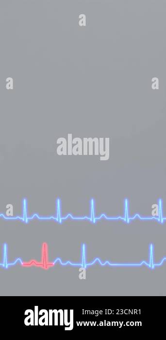 Comparison of ECG of normal heart rhythm and AV block 2nd degree ...