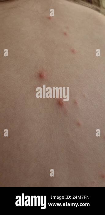 Measles rash back Stock Videos & Footage - HD and 4K Video Clips - Alamy