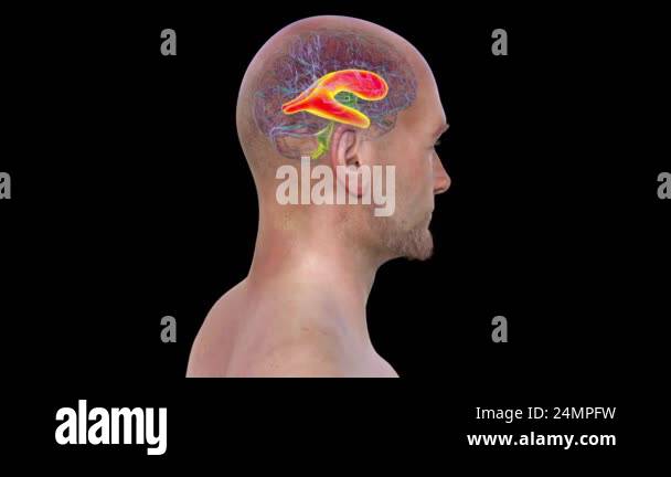 Animation depicting a man with enlarged lateral ventricles of the brain ...