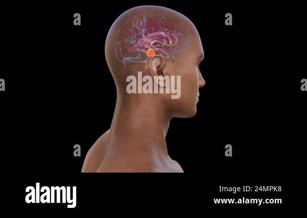 Animation depicting enlarged lateral and third ventricles of the brain ...