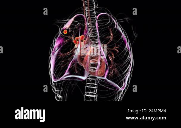 Animation of primary lung tuberculosis, featuring the Ghon complex ...