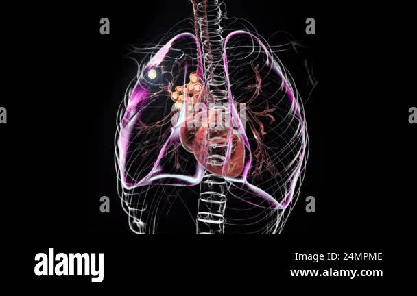 Animation of lungs with primary tuberculosis and Ranke complex ...