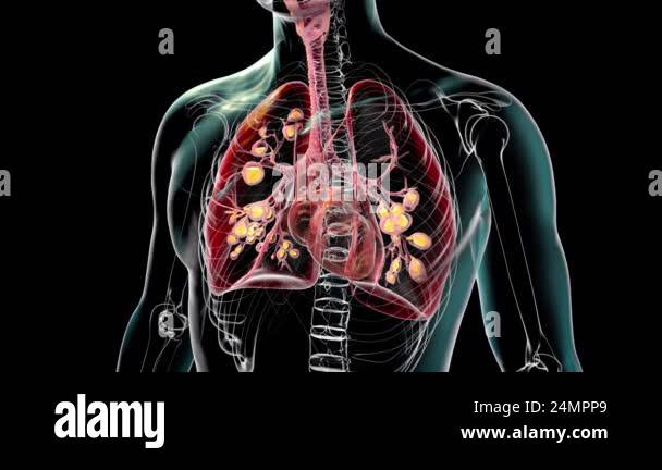 Animation of lungs affected by cystic fibrosis, a genetic disorder ...