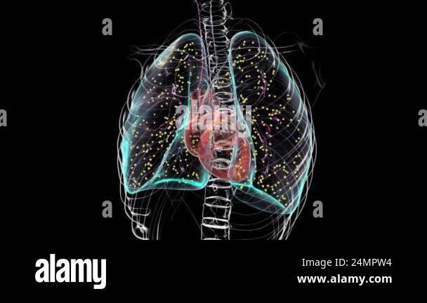 Animation of human lungs affected by miliary tuberculosis, illustration ...