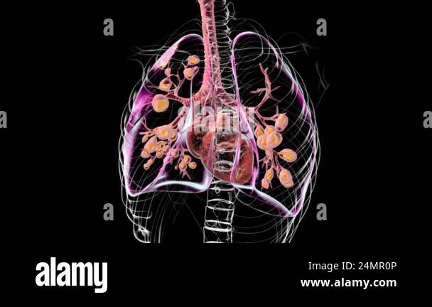Animation of lungs affected by cystic fibrosis, a genetic disorder ...