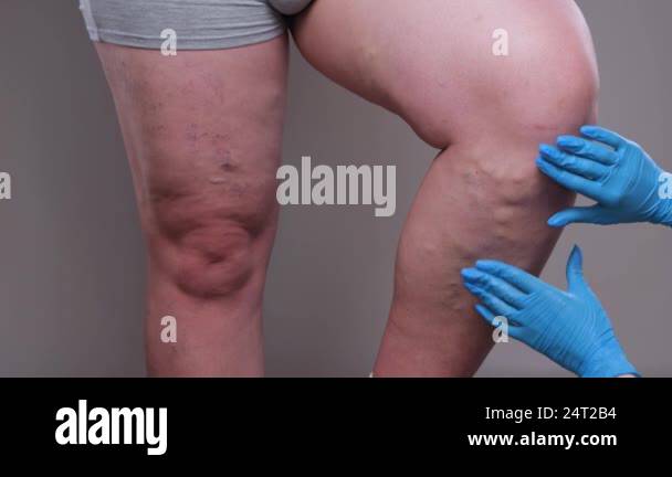 Removal of varicose veins on the legs. Medical inspection and treatment ...