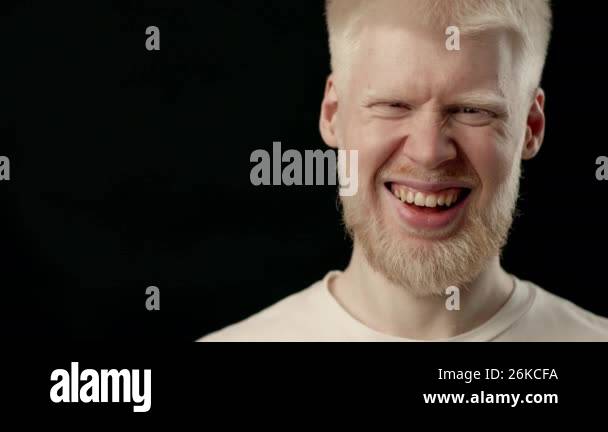 A young man with albinism is smiling warmly while wearing a light ...