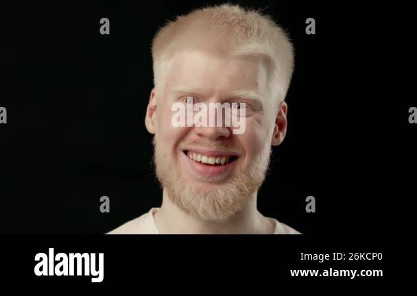 A young man with albinism shows a bright smile, highlighting his white ...