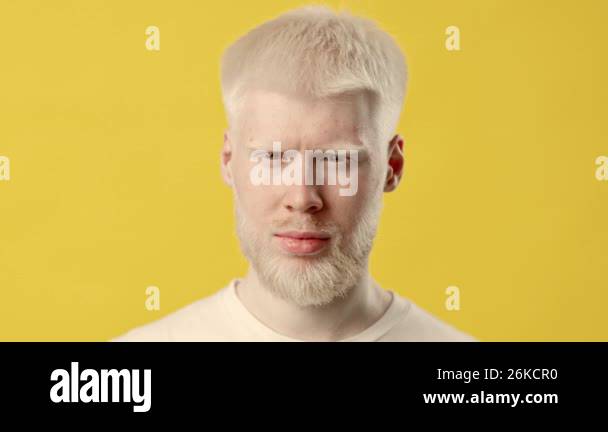 A young man with albinism stands confidently, showcasing his striking ...