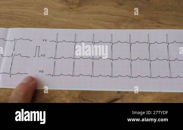 Doctor is looking at the patient's electrocardiogram ECG, EKG Stock ...