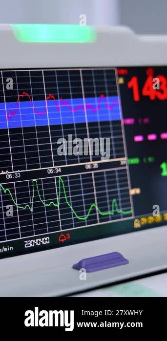 Screen of CTG device working in hospital ward. Close up. Medical ...