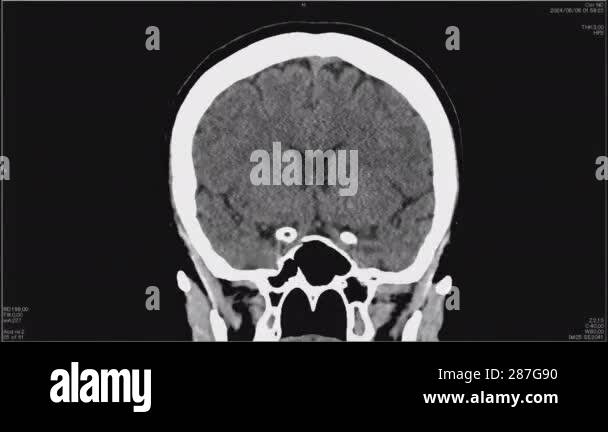 Magnetic resonance images of the brain, MRI of the brain, of a patient ...