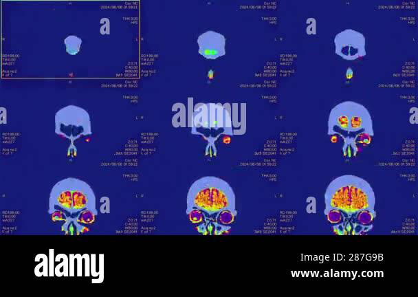 Magnetic resonance images of the head and neck, MRI of the brain, front ...