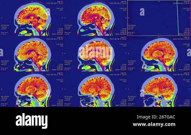 Magnetic resonance images of the head and neck, MRI of the brain, side ...