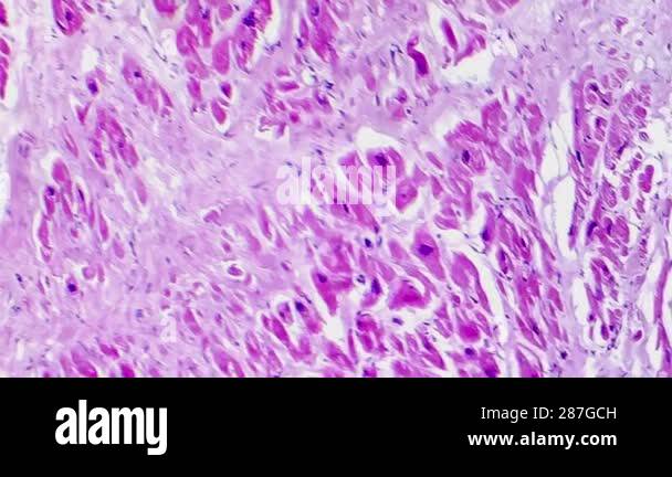 Myocardial infarction, light microscopy showing damaged heart tissue ...